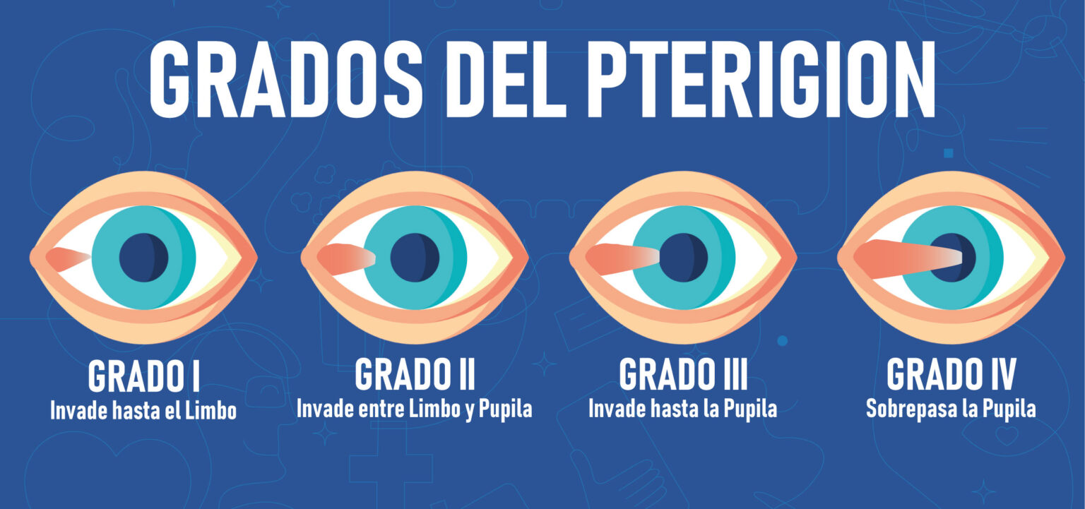 Cirugía de pterigión - Clínica Oftalmológica del Caribe