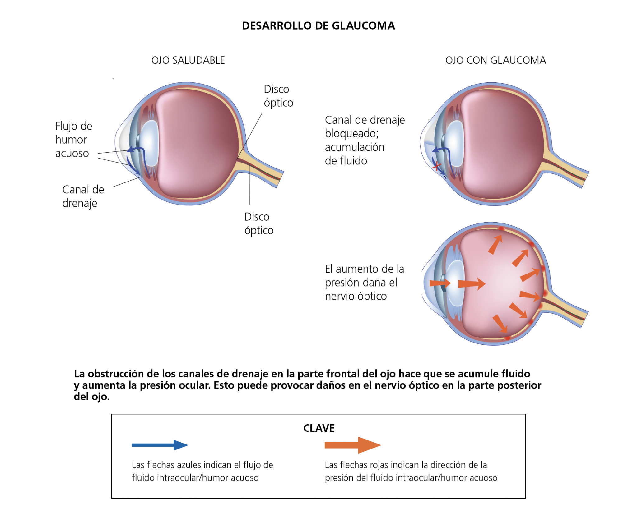 Diabetes Y Glaucoma Riesgos Prevención Y Cuidado Ocular